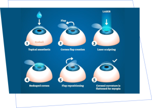 LASIK Eye Surgery in Sydney | LASIK Laser Eye Surgery