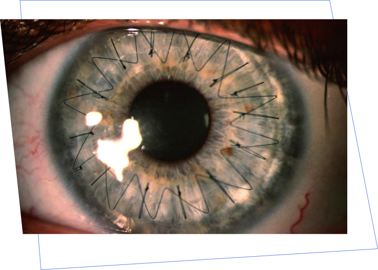 PKP - Penetrating Keratoplasty Eye Surgery | Vision Clinic Sydney