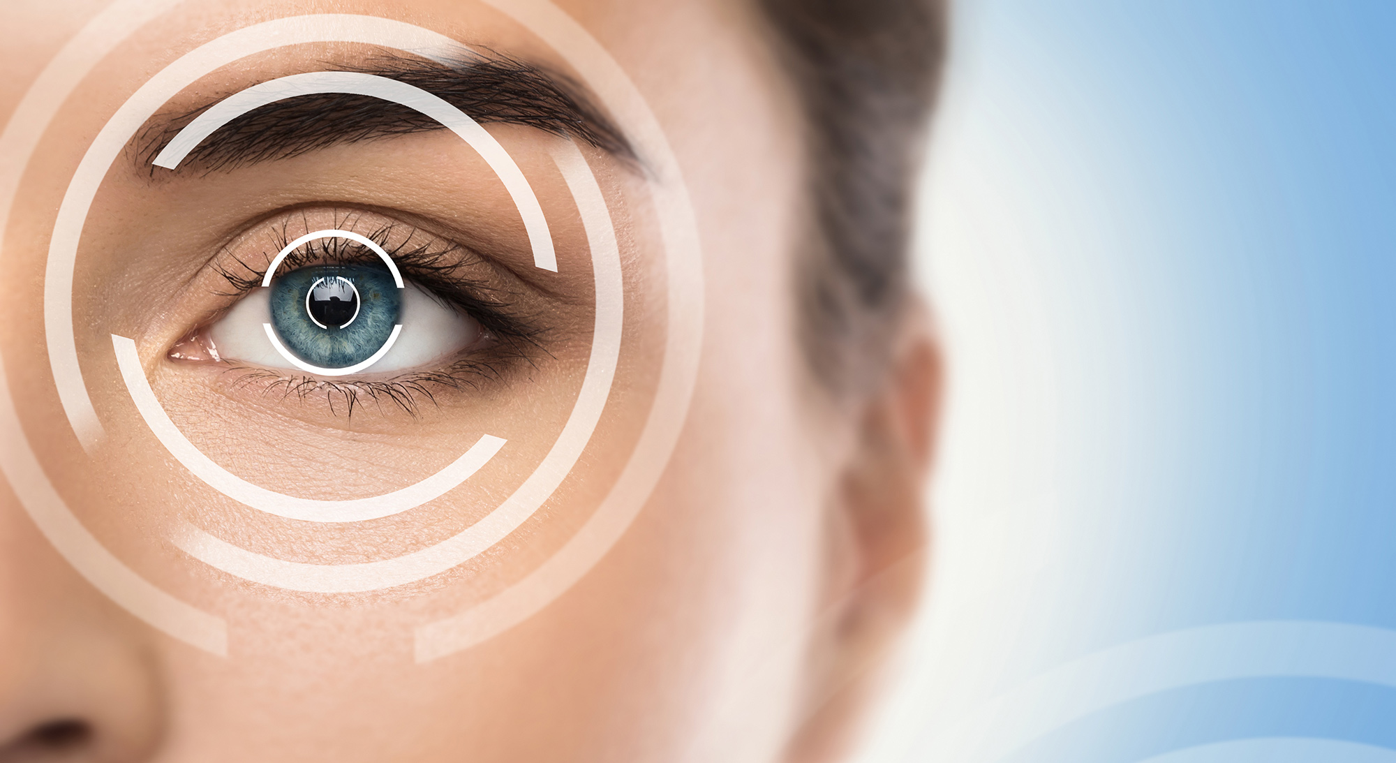 Contact Lenses vs LASIK | Vision Clinic Sydney