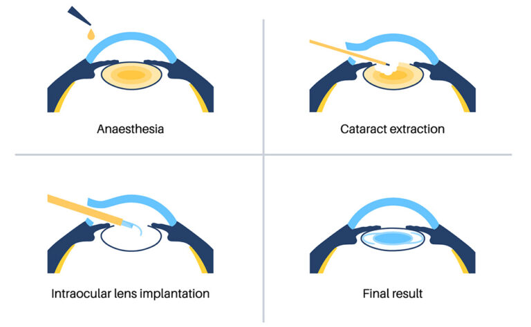 Cataract Surgery: A Step by Step Guide | Vision Clinic Sydney