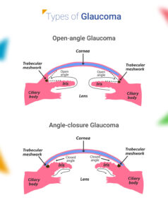 Glaucoma Warning Signs and Early Symptoms | Vision Clinic
