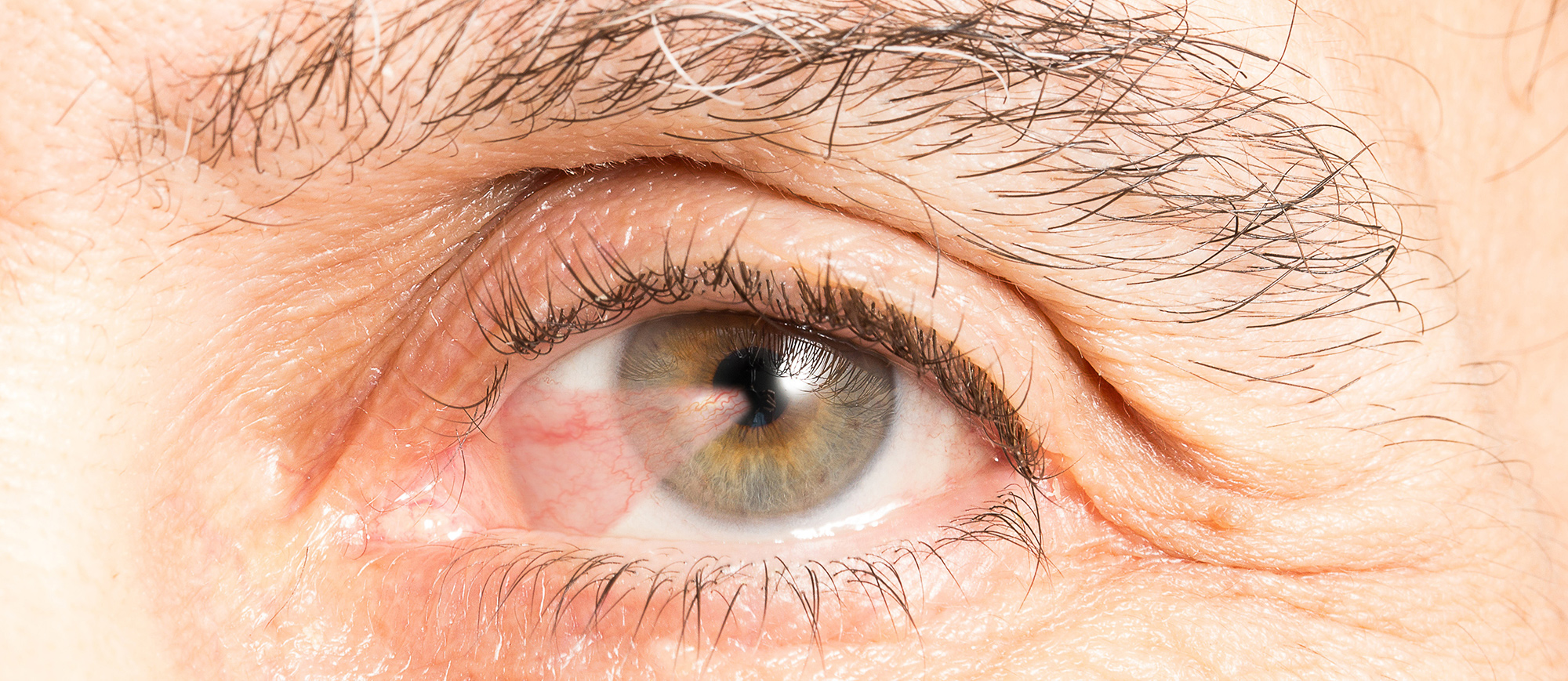What Is a Pterygium? Causes, Symptoms & Diagnosis